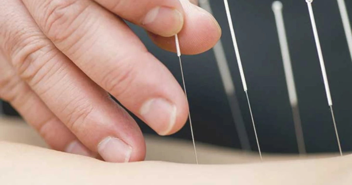 Does Acupuncture For Spinal Injury Help In Quicker Healing?