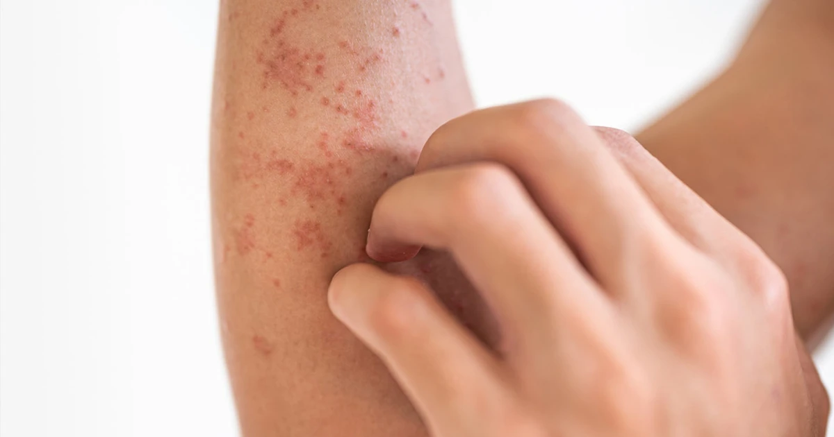 Skin Fungus Infection - An Overview Of How It Can Be Treated