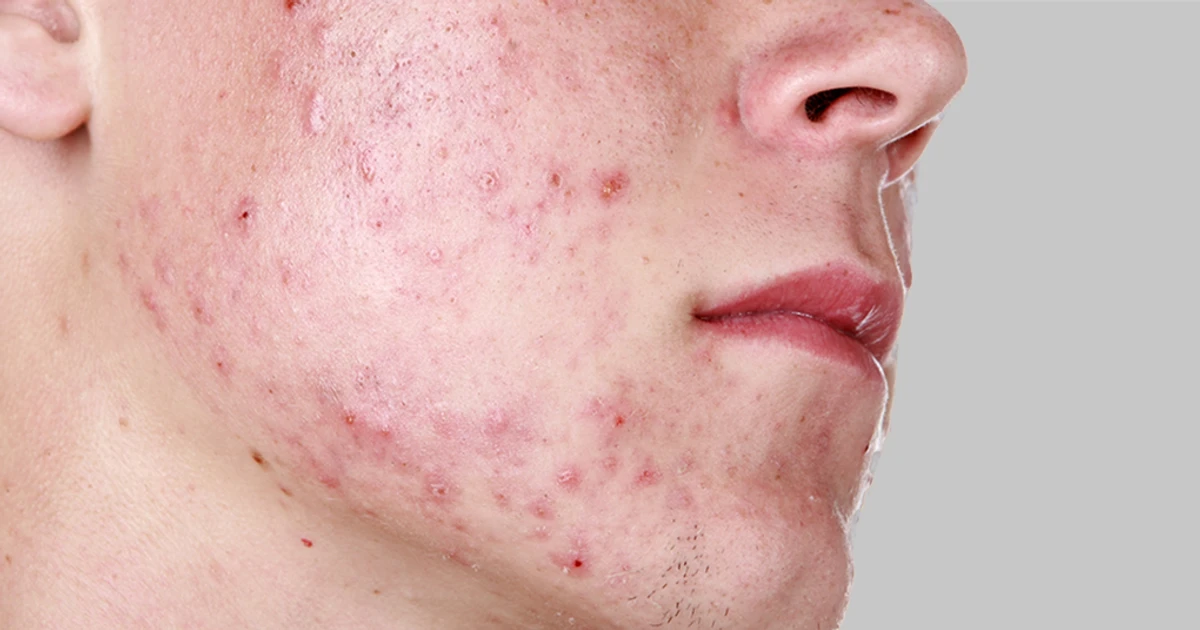 Acne Treatment Breakthroughs - Revolutionary Solutions For Clearer Skin